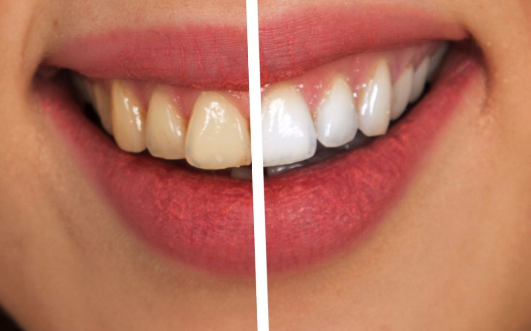 Have Discoloured Teeth? | Causes, Treatments & Options